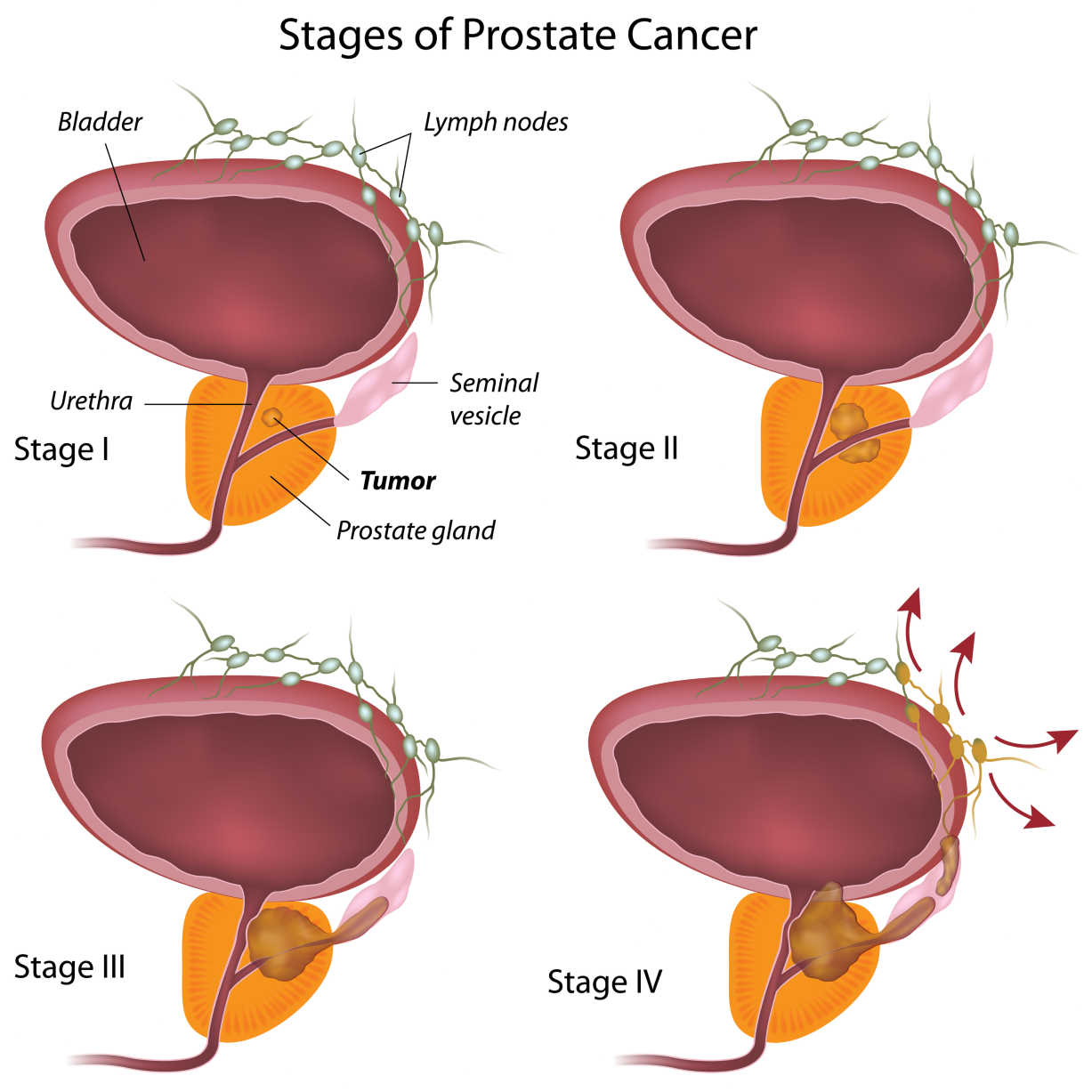 How Prostate Cancer Affects Black Men: What Can We Do About It ...